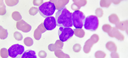 Sylvester Researchers Play Key Role in Groundbreaking AML Study - InventUM