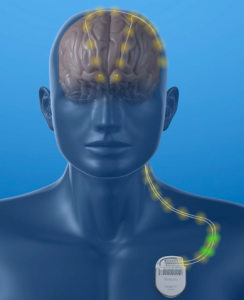 UHealth Neurosurgeon Implants Latest Two-way Deep Brain Stimulation ...