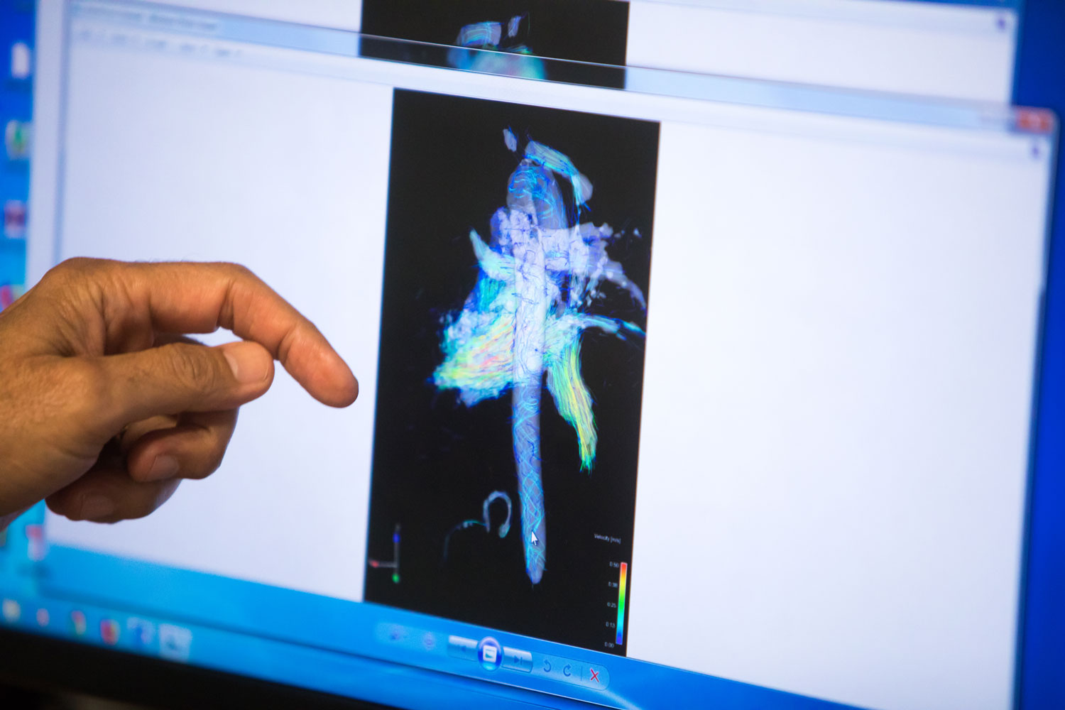 UM’s AFib Center Delivers Advanced Care and Innovative Research to ...