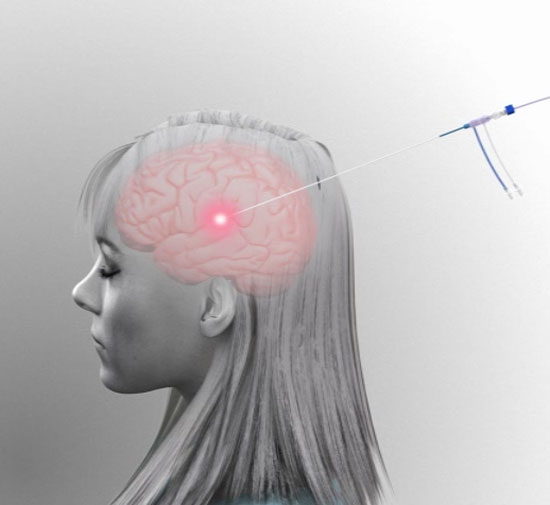 Laser Therapy Shows Promise for Patients with Refractory Epilepsy ...