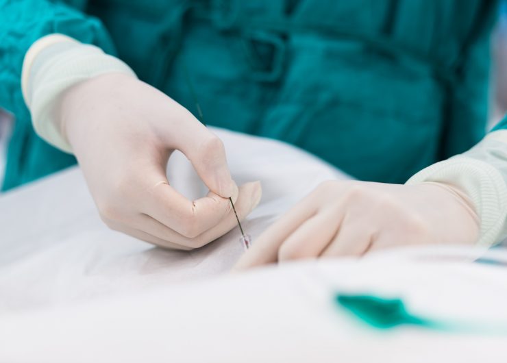 Stroke Stent-Retriever Device Saves Patient with Blocked Coronary ...